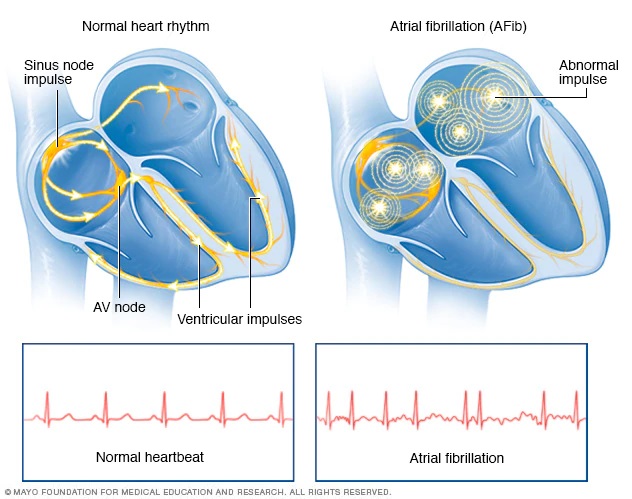 Atrial Fibrillation – A Brief Overview – CPR Counts